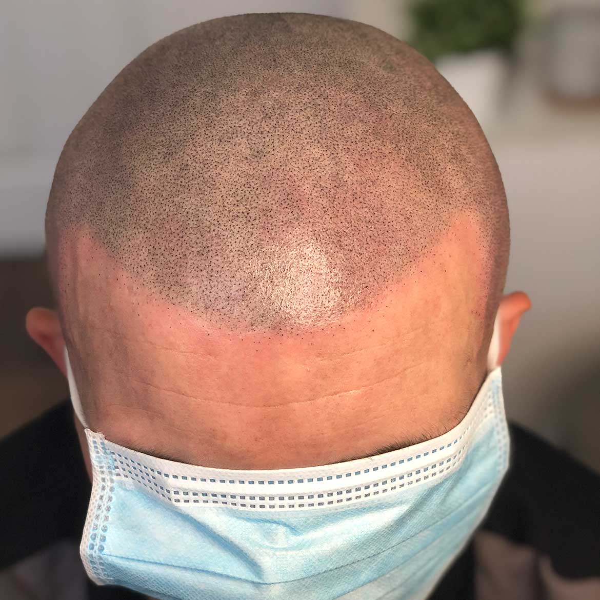 Gallery - Hairline Back