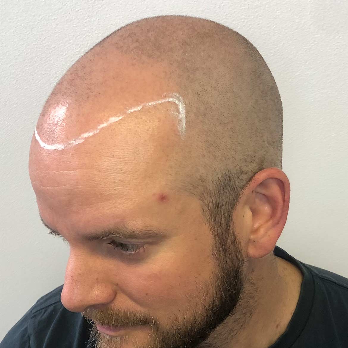 Gallery - Hairline Back