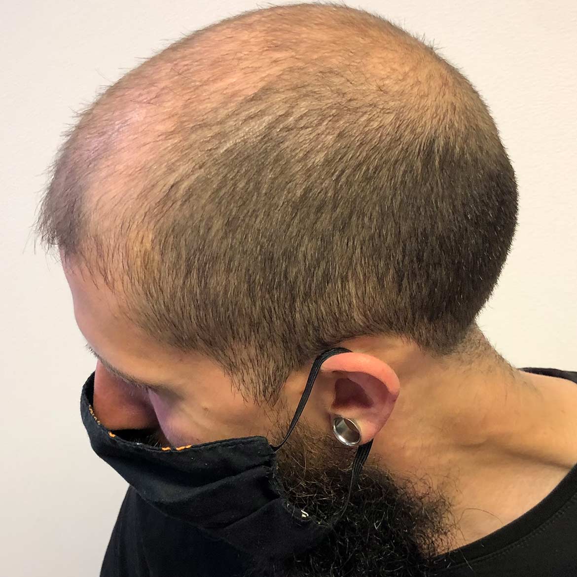 Gallery - Hairline Back