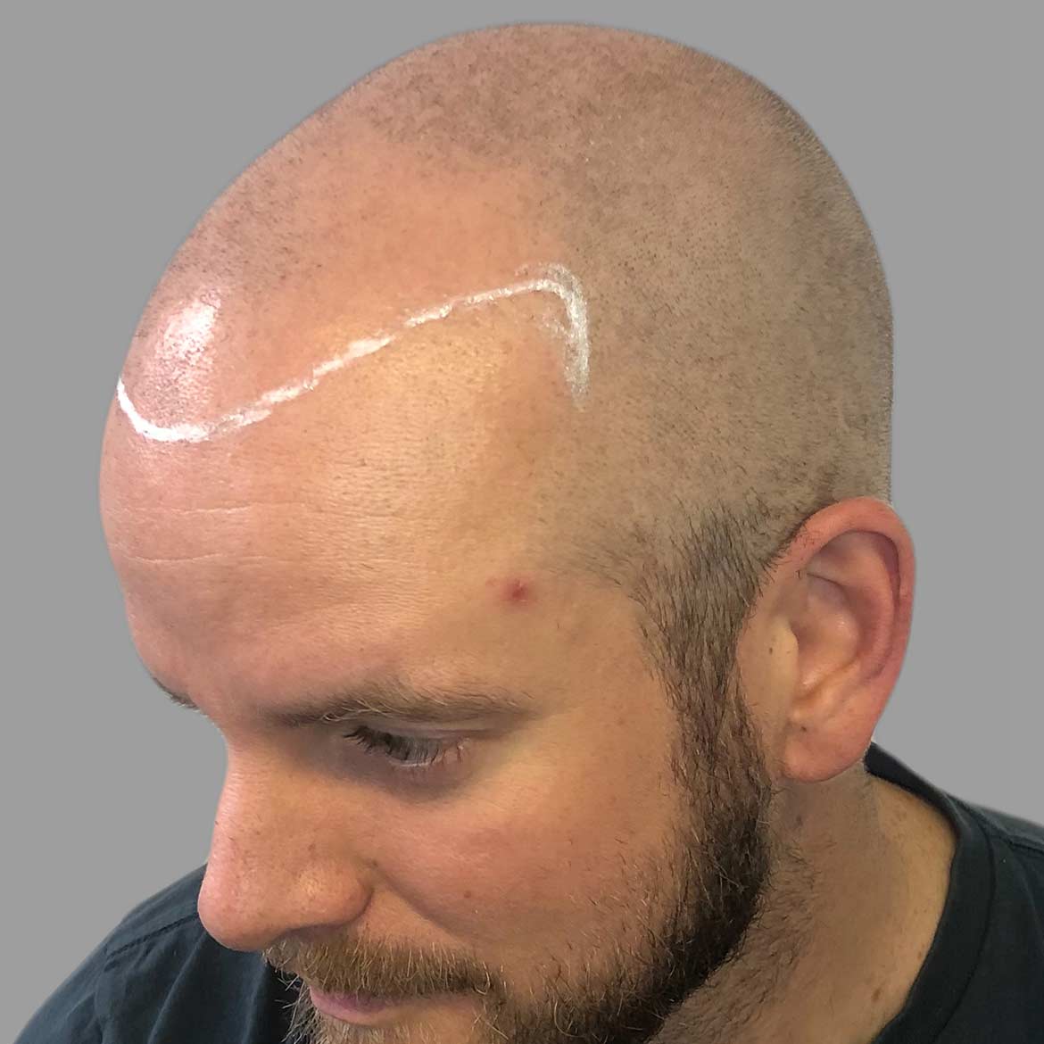 Gallery - Hairline Back