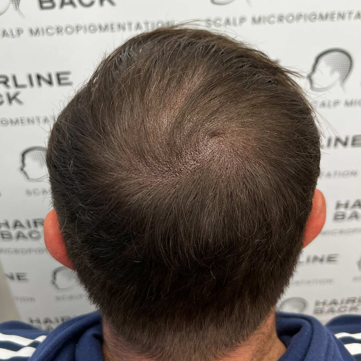 Gallery - Hairline Back