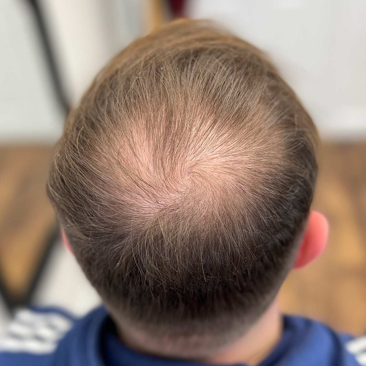 Gallery - Hairline Back