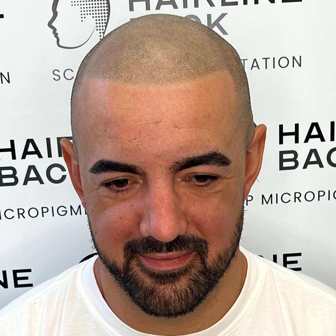 Gallery - Hairline Back