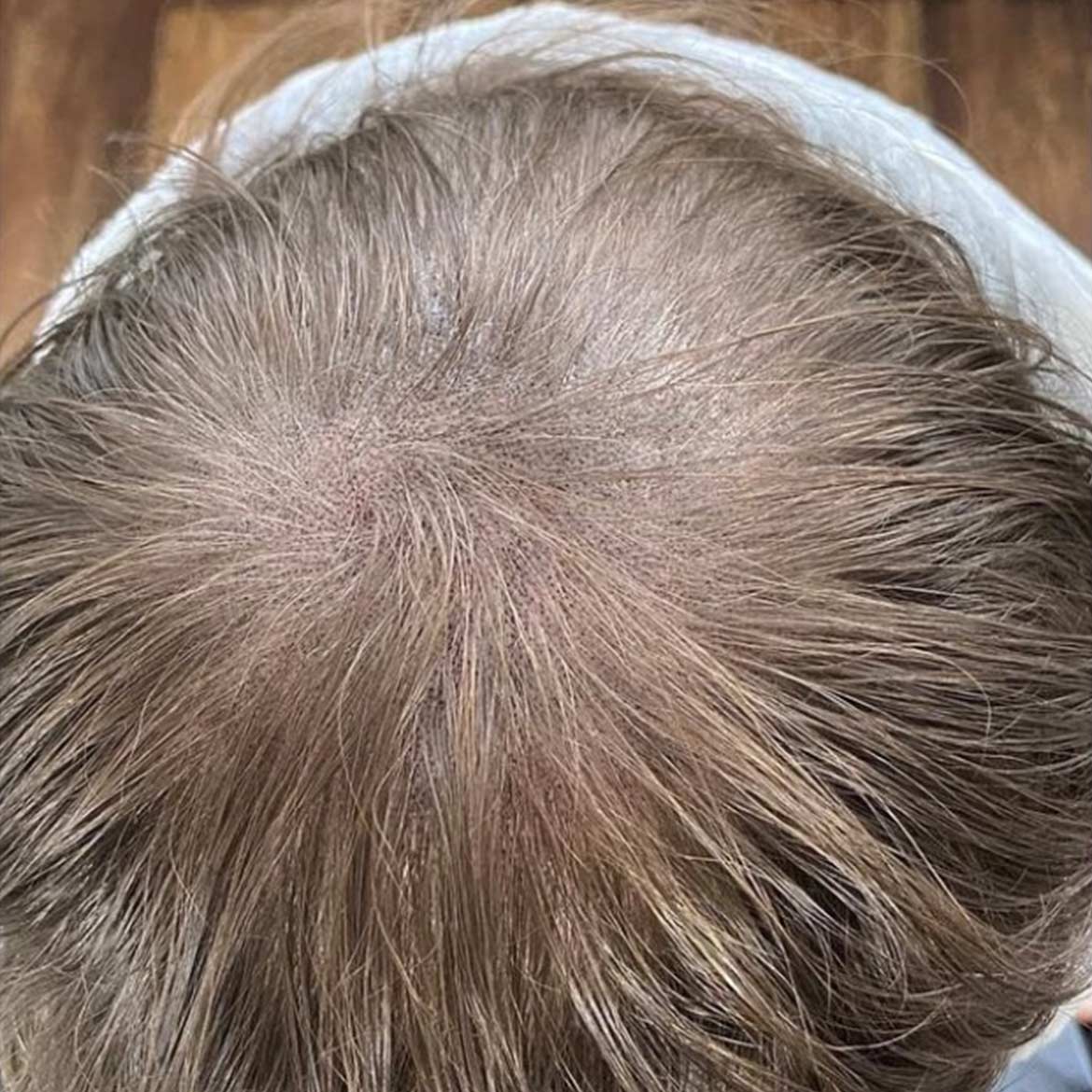 Gallery - Hairline Back