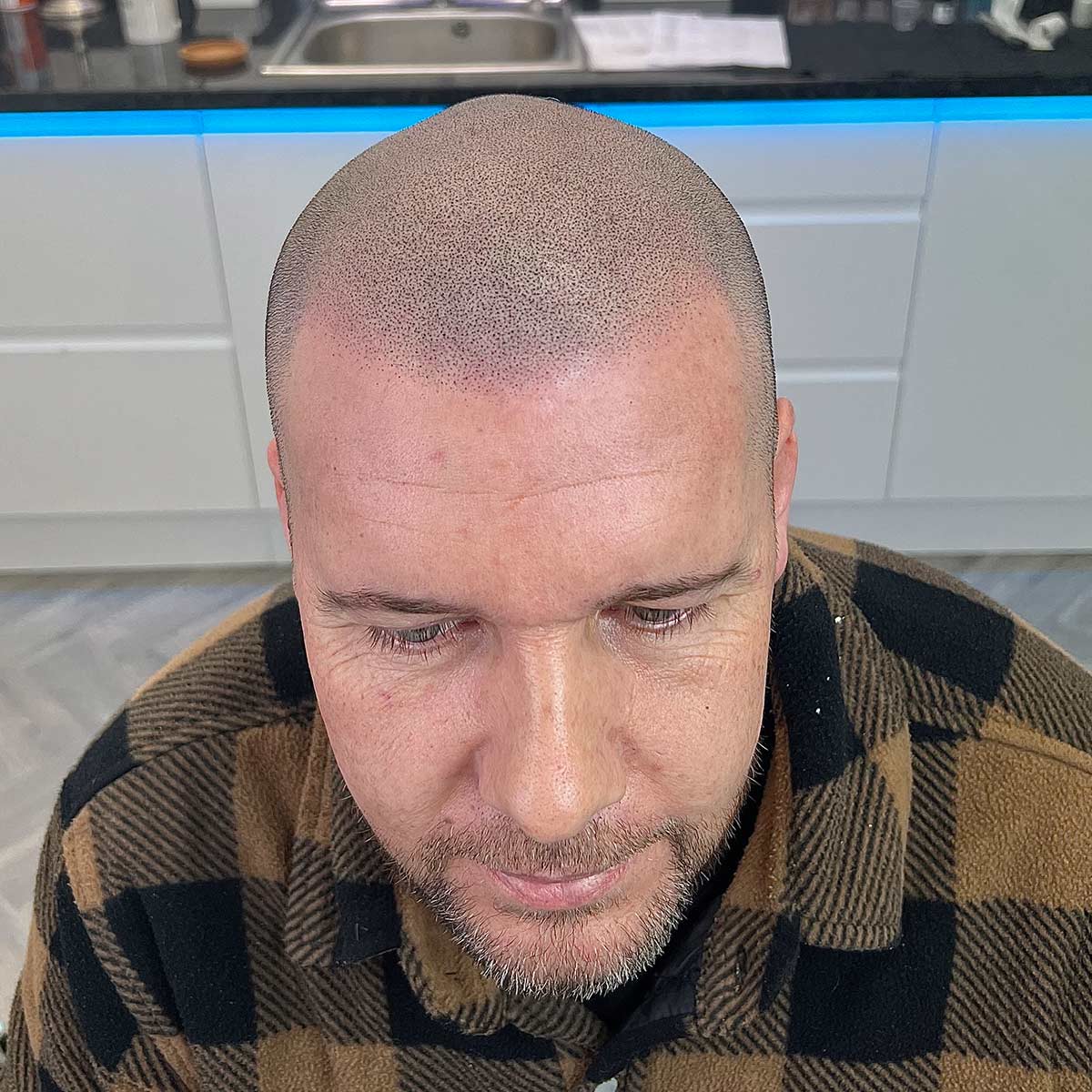 Gallery - Hairline Back