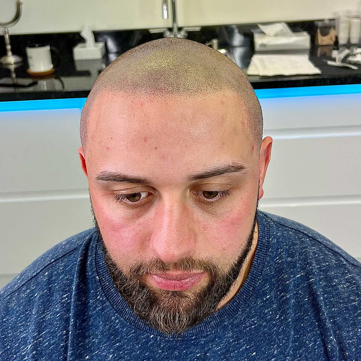 Gallery - Hairline Back