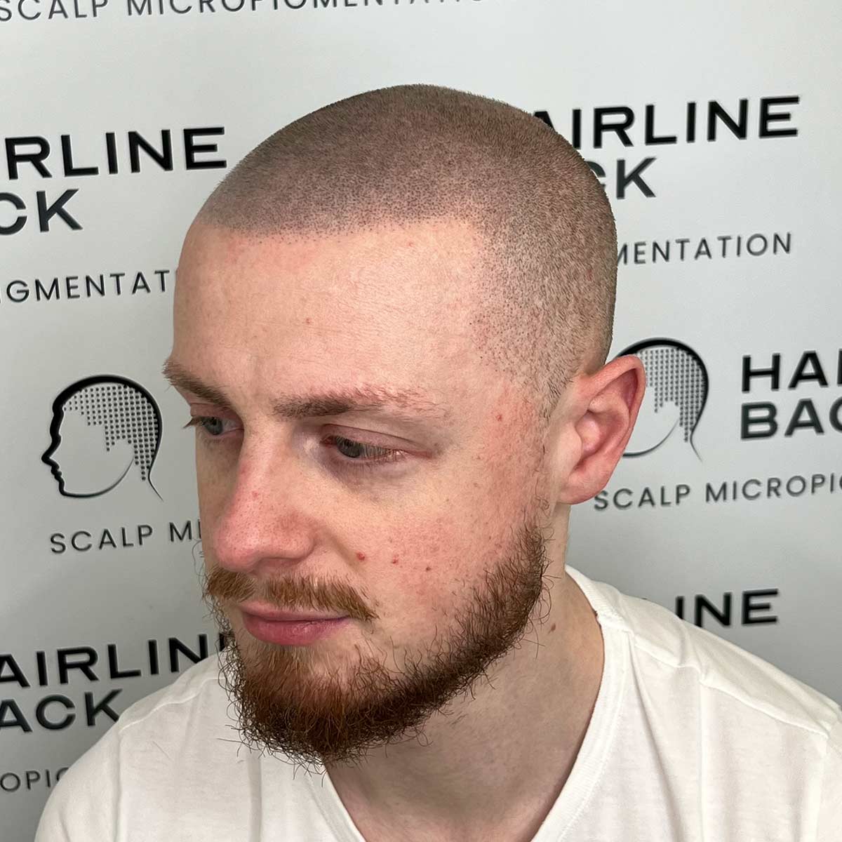 Gallery - Hairline Back