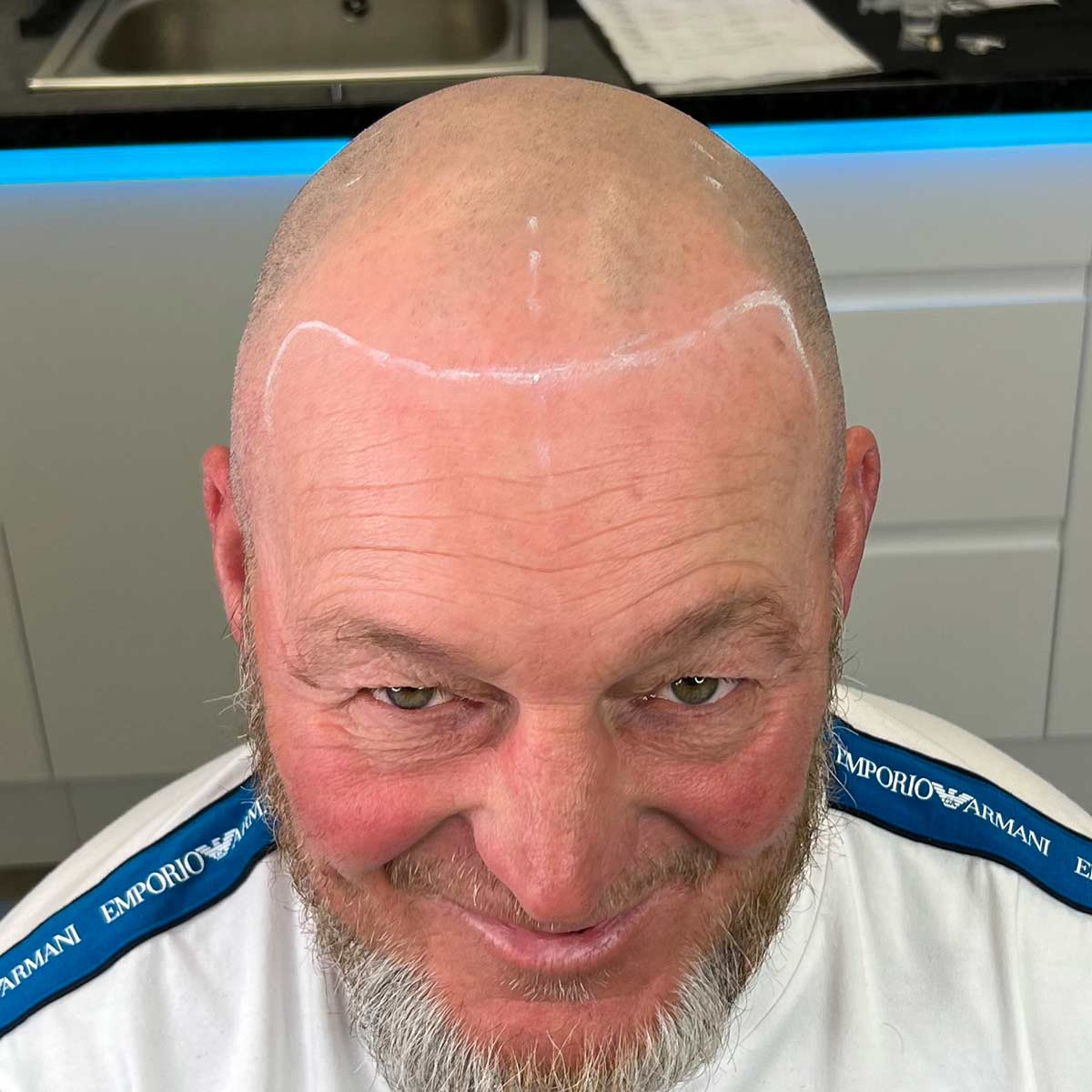 Gallery - Hairline Back