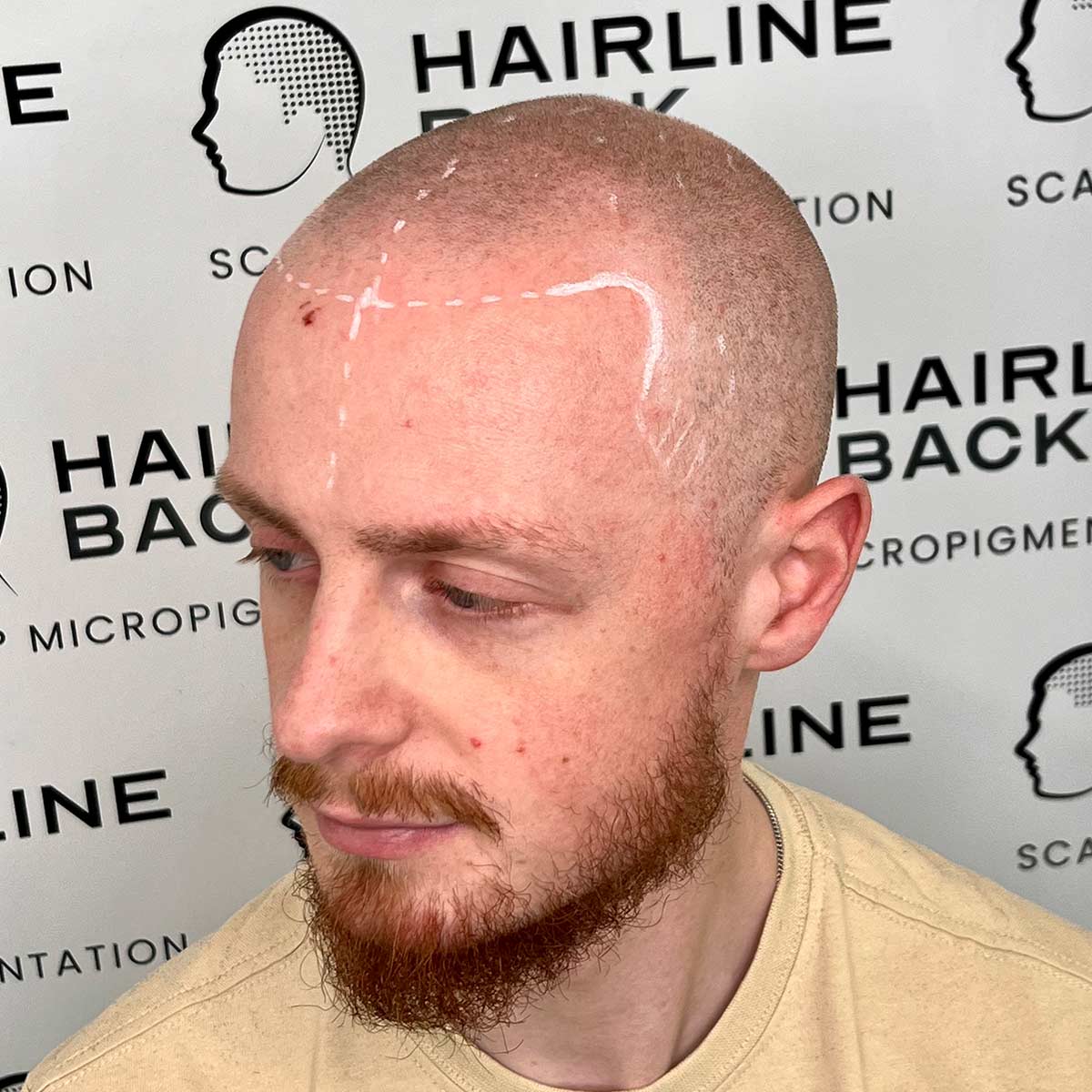 Gallery - Hairline Back